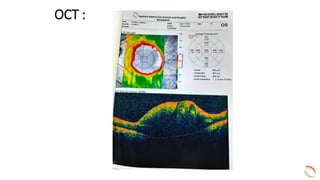 Retinal Artery Macroaneurysm | PPTX