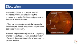 Retinal Artery Macroaneurysm | PPTX
