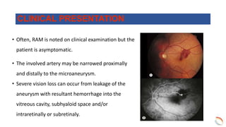 Retinal Artery Macroaneurysm | PPTX