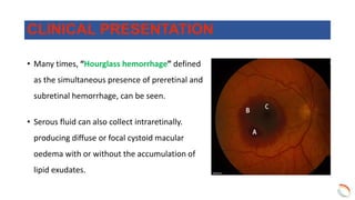 Retinal Artery Macroaneurysm | PPTX