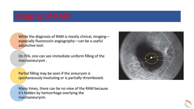 Retinal Artery Macroaneurysm | PPTX | Eye and Vision Conditions ...