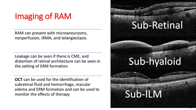 Retinal Artery Macroaneurysm | PPTX | Eye and Vision Conditions ...