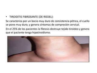 TIROIDITIS | PPTX
