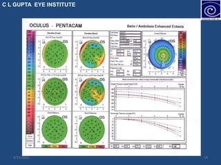 corneal topography by ramji pandey ...C L GUPTA eye institute | PPTX