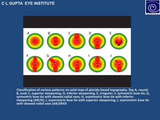 corneal topography by ramji pandey ...C L GUPTA eye institute | PPTX