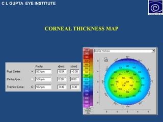 corneal topography by ramji pandey ...C L GUPTA eye institute | PPTX