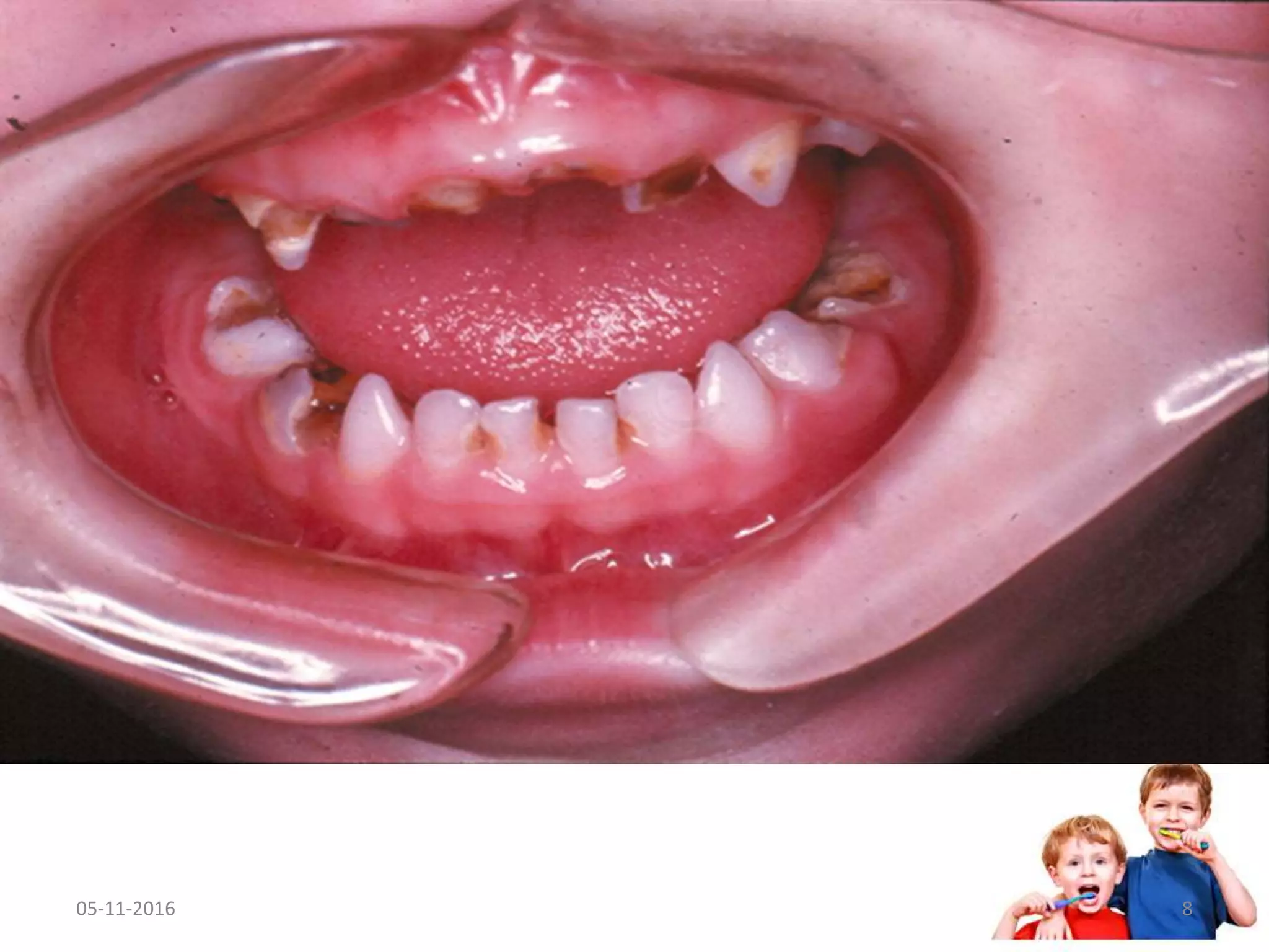 Rampant caries and chemico machanical removal of caries | PPT | Free ...