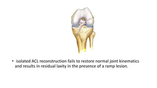Ramp lesion | PPTX
