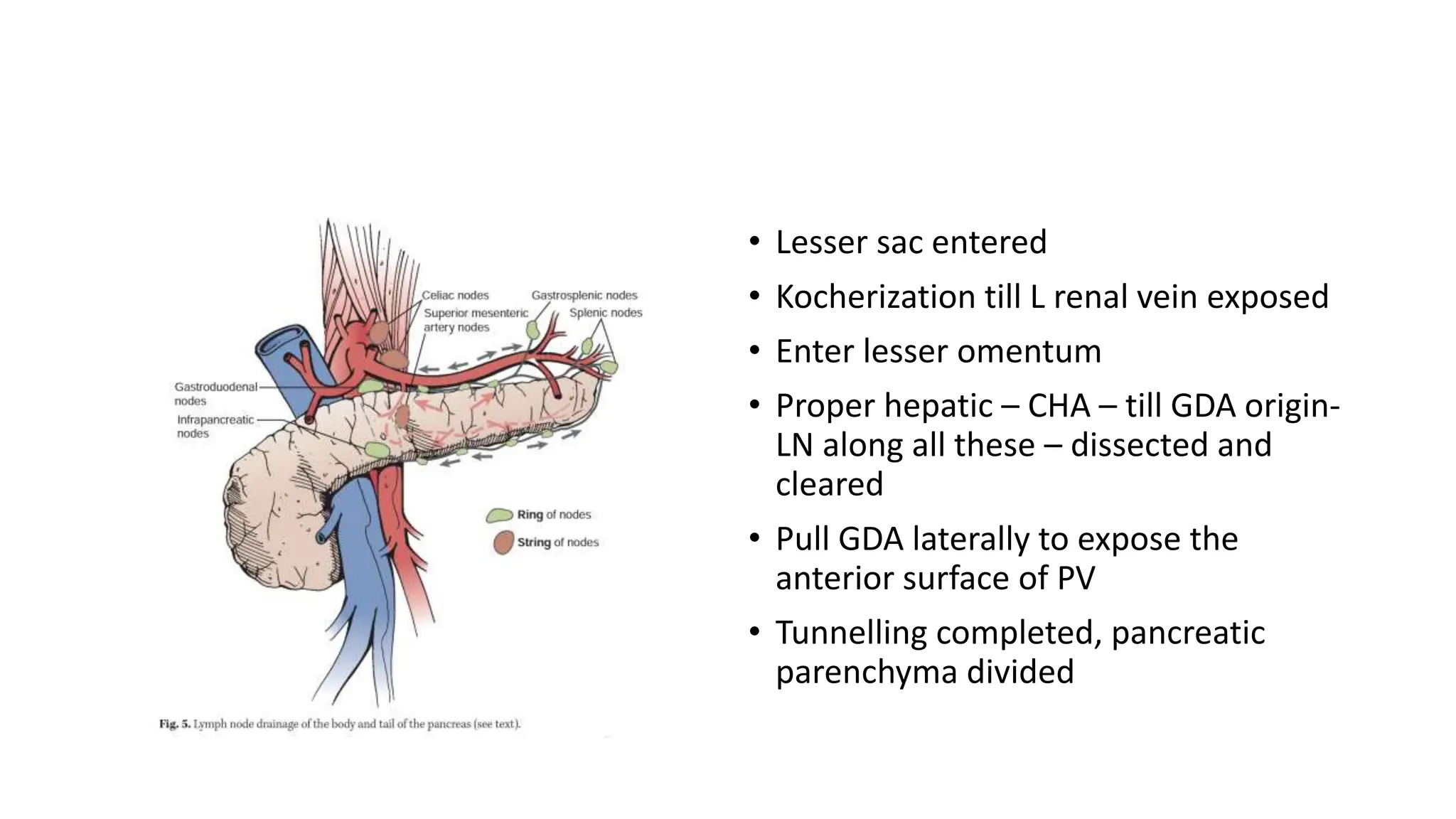 RAMPS.pptx surgery of pancreas done for radical resection | PPTX