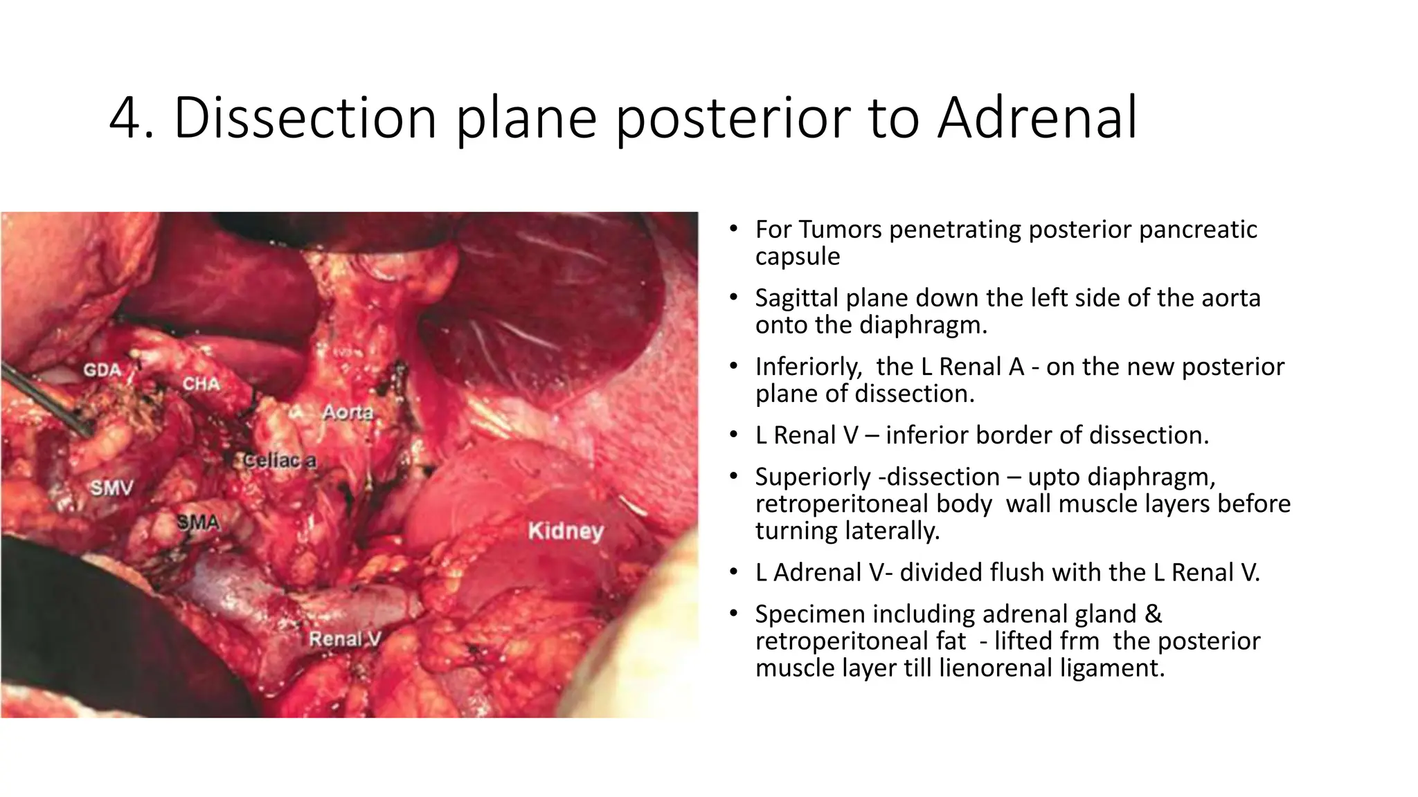 RAMPS.pptx surgery of pancreas done for radical resection | PPTX