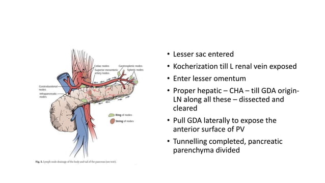 RAMPS.pptx surgery of pancreas done for radical resection | PPTX