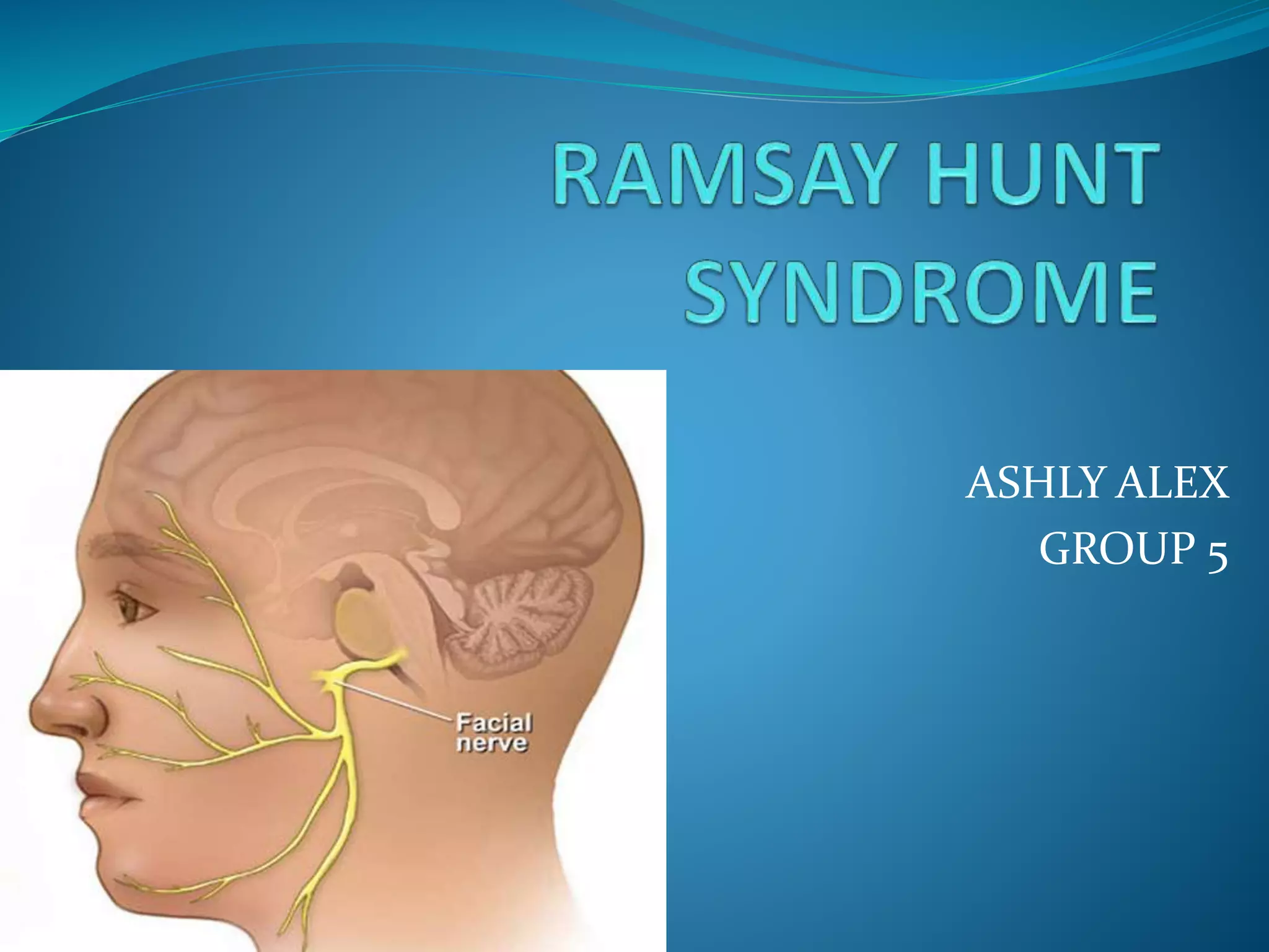 Ramsay Hunt Syndrome PPTX Ramsay Hunt Syndrome PPTX