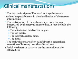 Ramsay hunt syndrome | PPTX