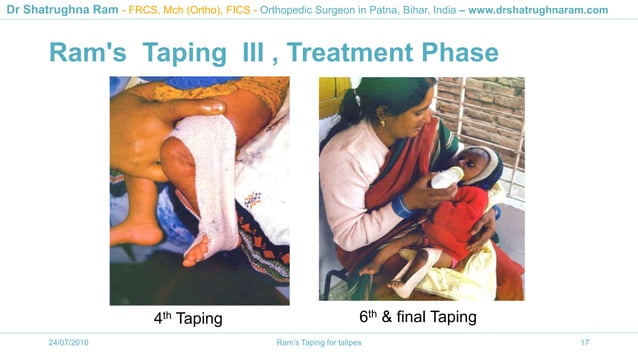 Ram’s Taping for talipes | PPTX | Foot Health | Diseases and Conditions