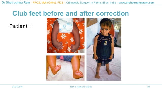 Ram’s Taping for talipes | PPTX | Foot Health | Diseases and Conditions