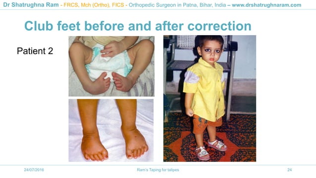 Ram’s Taping for talipes | PPTX | Foot Health | Diseases and Conditions