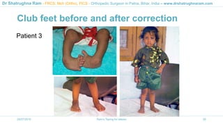 Ram’s Taping for talipes | PPTX