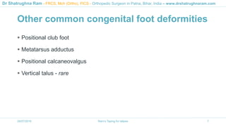 Ram’s Taping for talipes | PPTX