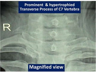 Ramu's sign to clinically elicit lower cervical spinal nerve traction ...