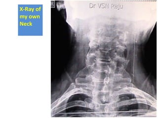 Ramu's sign to clinically elicit lower cervical spinal nerve traction ...