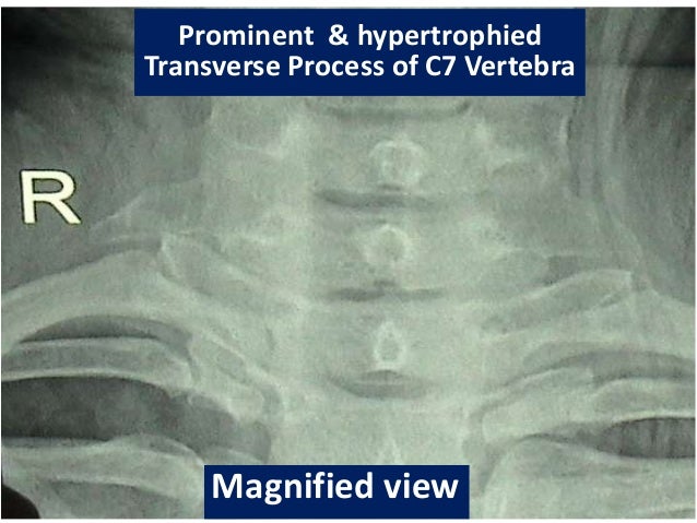Ramu's sign, brachialgia, Adson's test, C7 transverse process, hypert…