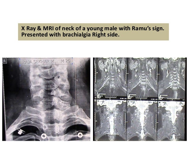 Ramu's sign, brachialgia, Adson's test, C7 transverse process, hypert…