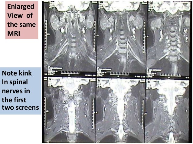 Ramu's sign, brachialgia, Adson's test, C7 transverse process, hypert…