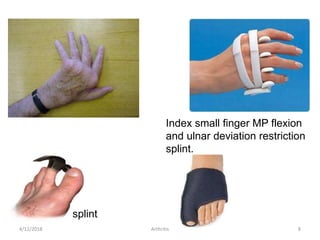 Rheumatoid arthritis Mx | PPT