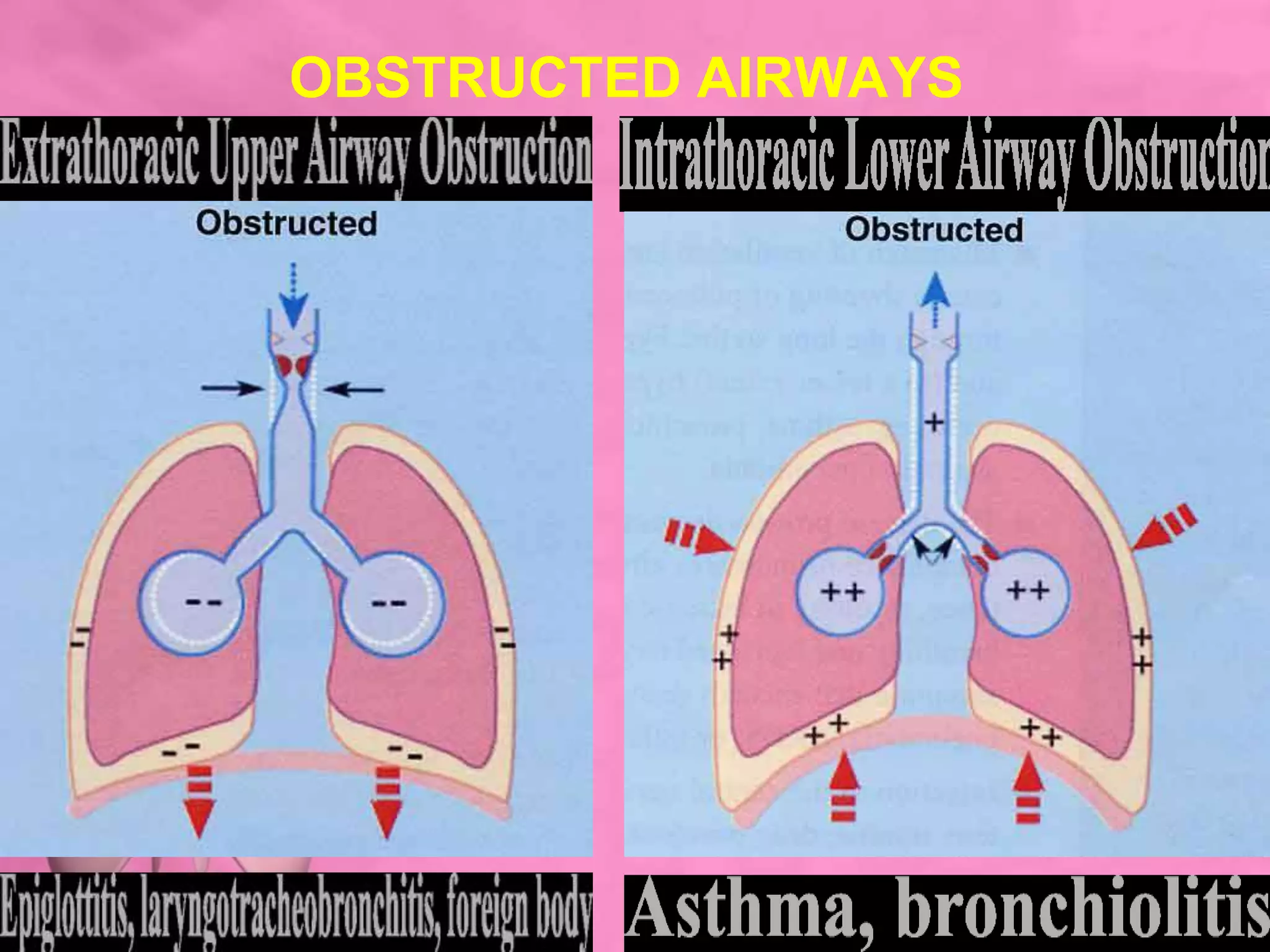 upper & lower airway obstruction | PPTX