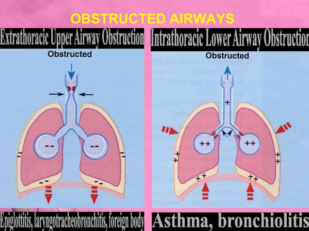 upper & lower airway obstruction | PPTX | Lung and Respiratory Health ...
