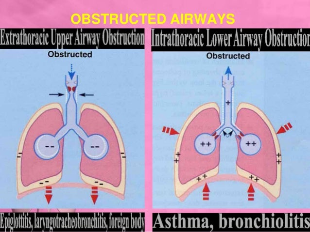 upper & lower airway obstruction