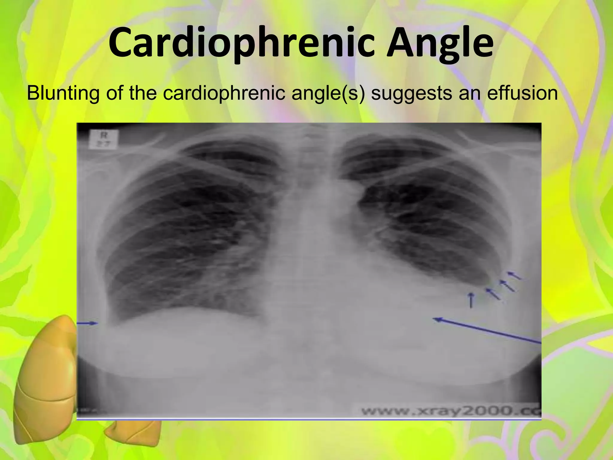 Cardiophrenic angle | PPTX