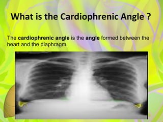 Cardiophrenic angle | PPTX
