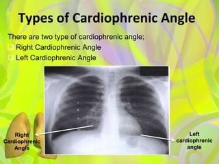 Cardiophrenic angle | PPT