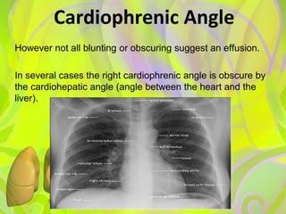 Costophrenic Angle