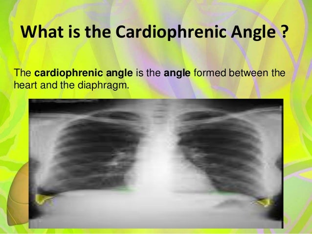 Cardiophrenic angle