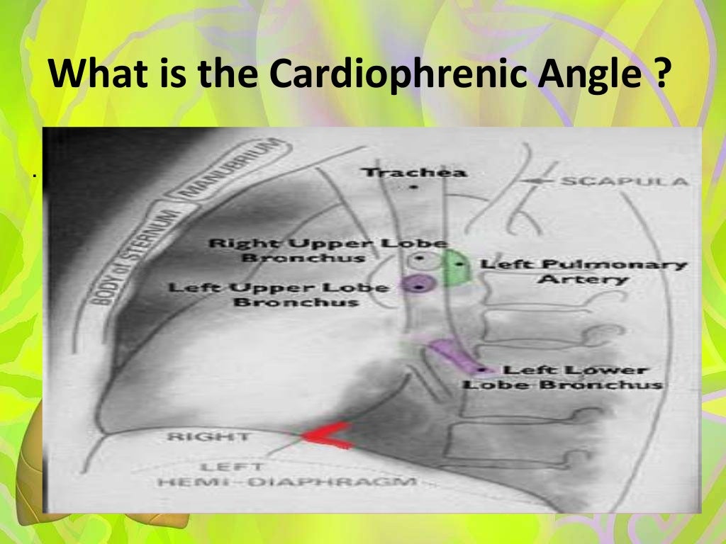 Cardiophrenic angle