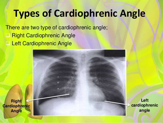 Cardiophrenic angle
