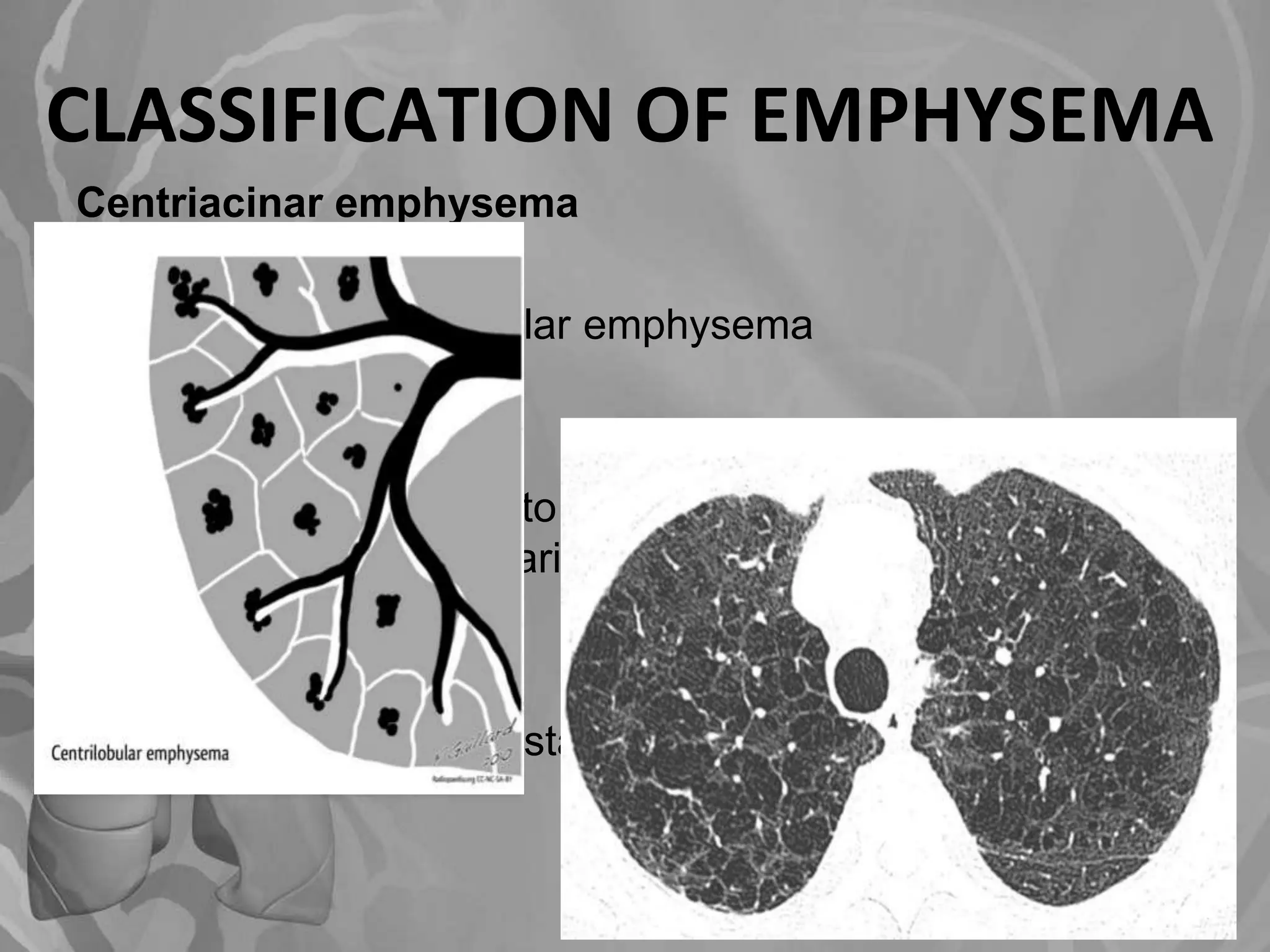 Emphysema | PPTX