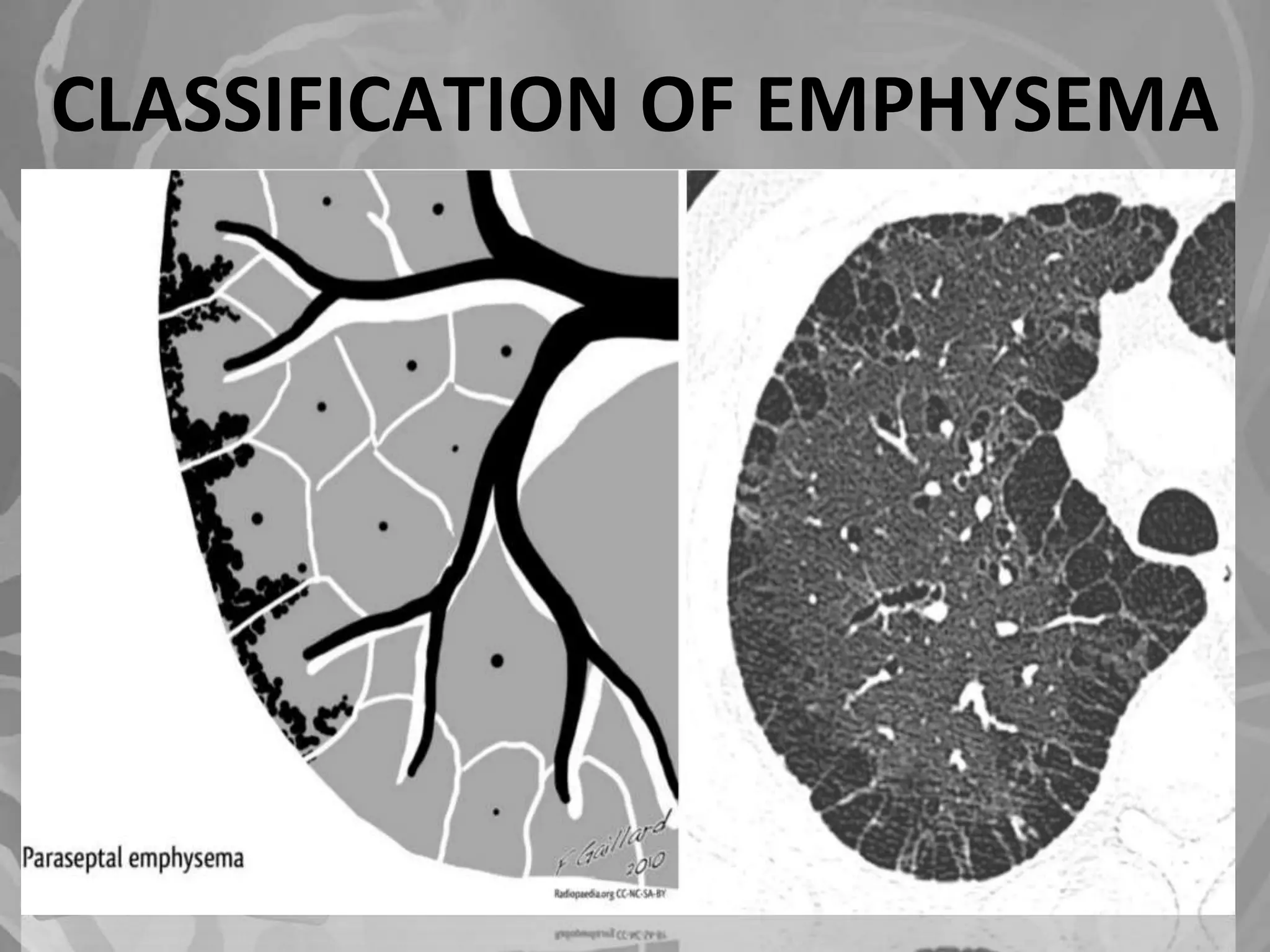 Emphysema | PPTX