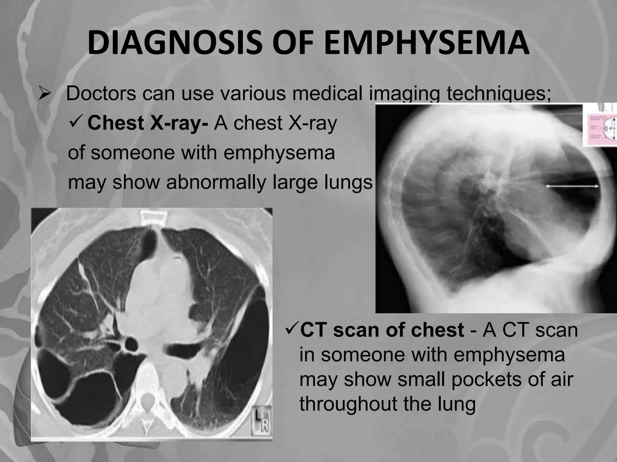 Emphysema | PPTX