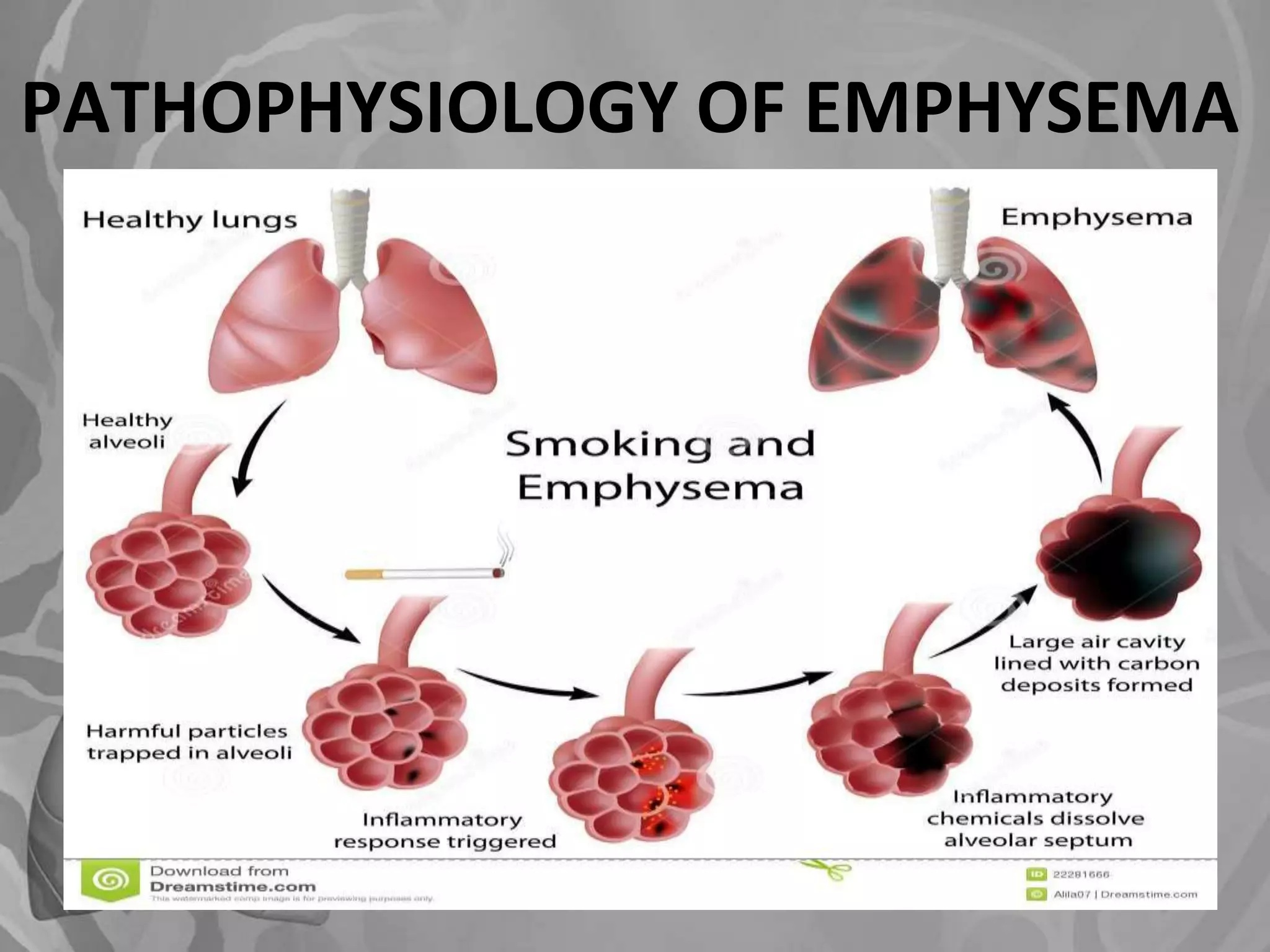 Emphysema | PPTX
