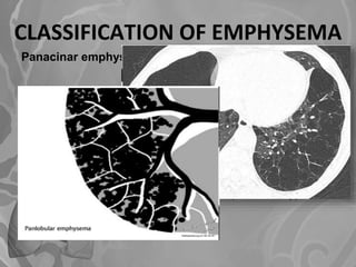 Emphysema | PPTX