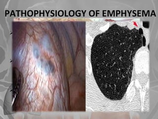 Emphysema | PPTX