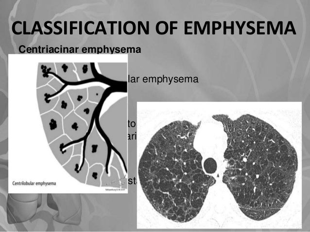 Emphysema