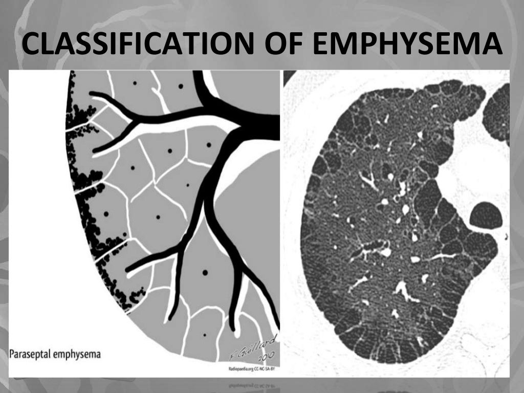 Emphysema