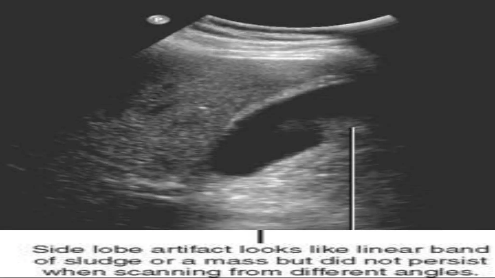 Side lobes and Harmonic Imaging | PPTX