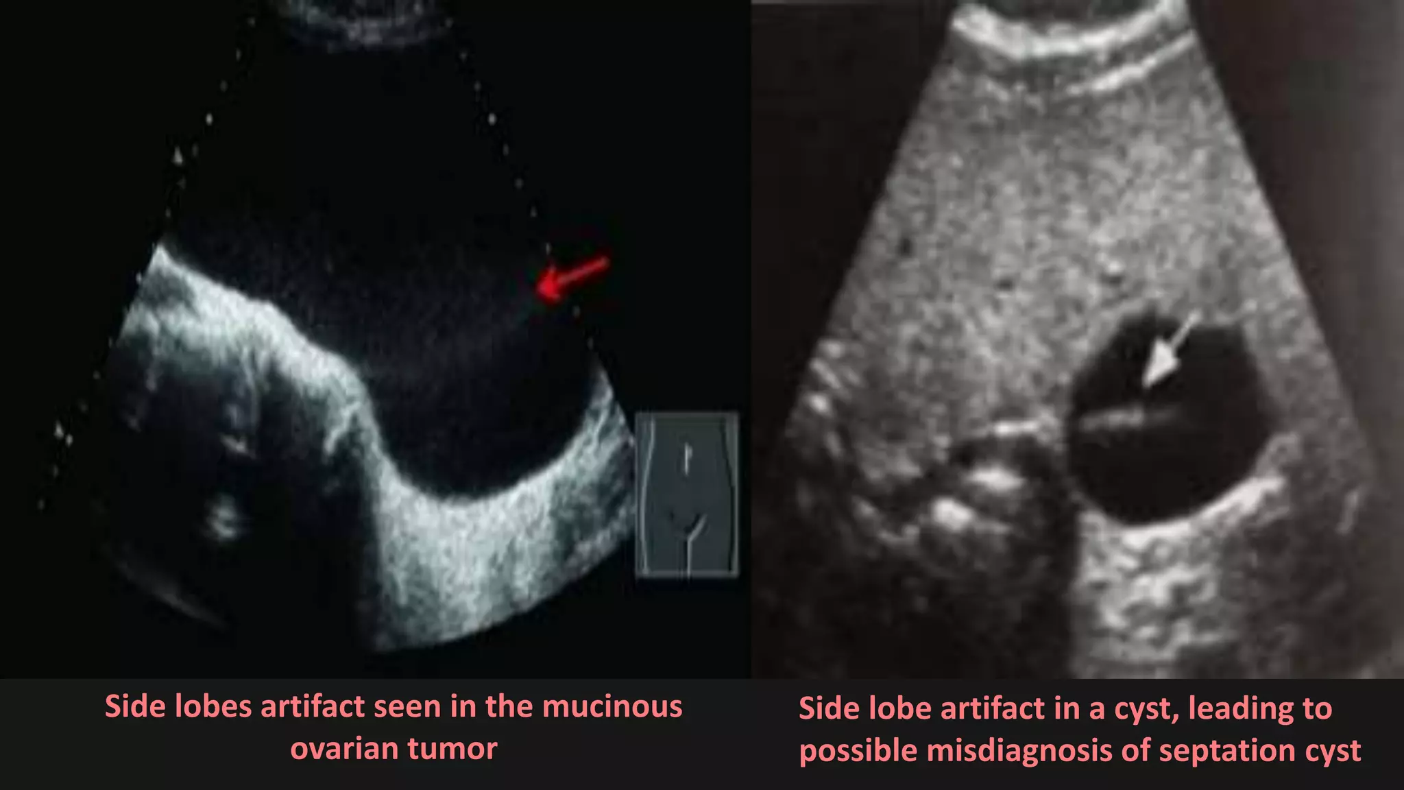 Side lobes and Harmonic Imaging | PPTX