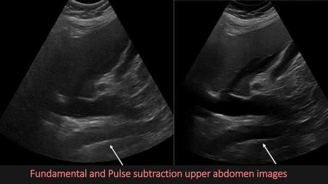 Side lobes and Harmonic Imaging | PPTX | Digital Audio | Computer ...