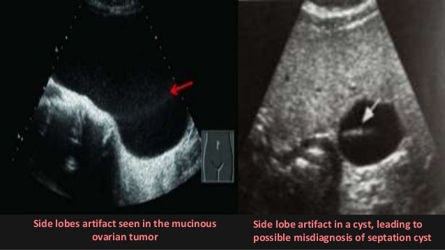 Side lobes and Harmonic Imaging